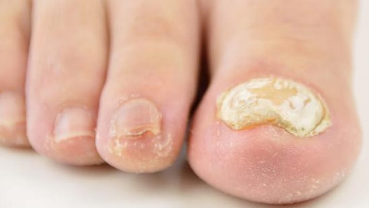 Thickened Toenails - Enable Podiatry